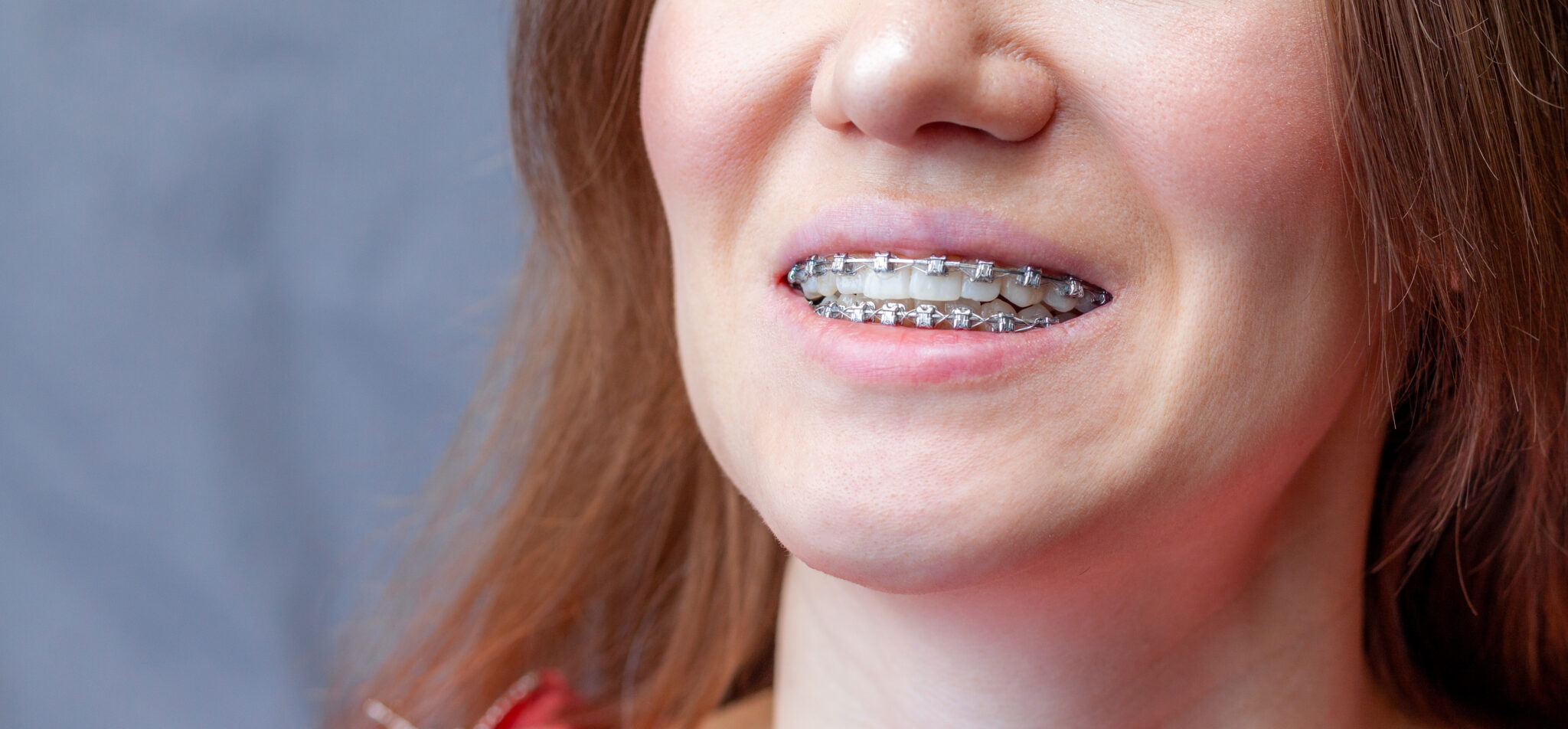 Underbite Correction – Dentist in Prescott, AZ | Horizon Dental of Prescott Underbite Correction – Dentist in Prescott, AZ | Horizon Dental of Prescott